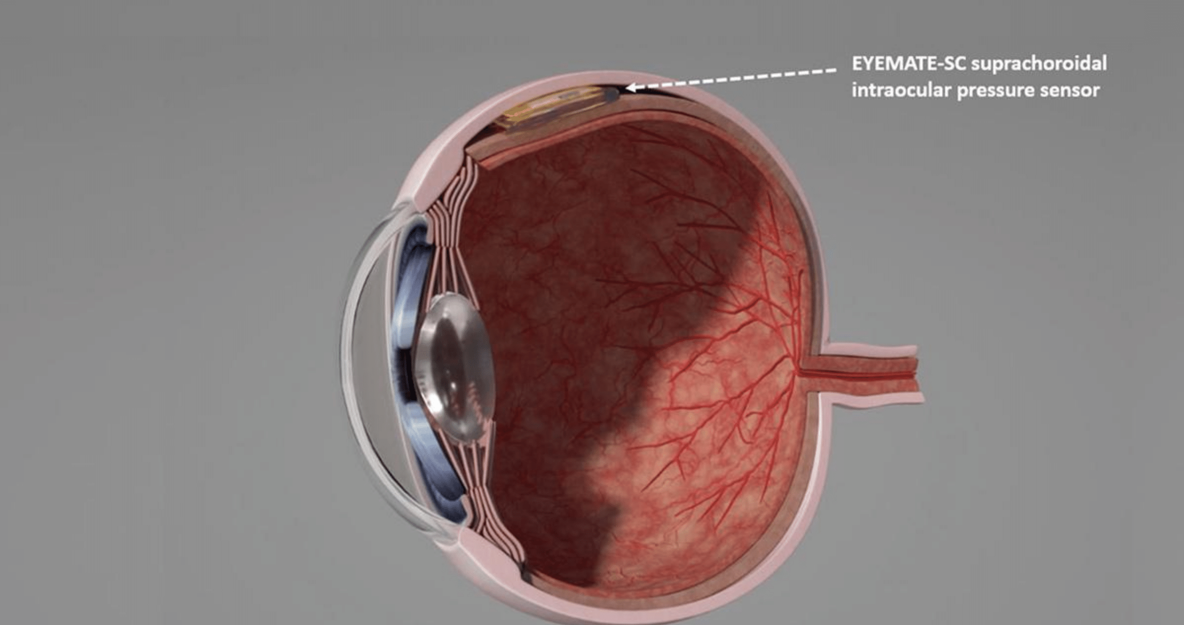 First Human Implanted with New Eye Pressure Sensor | Glaucoma Australia